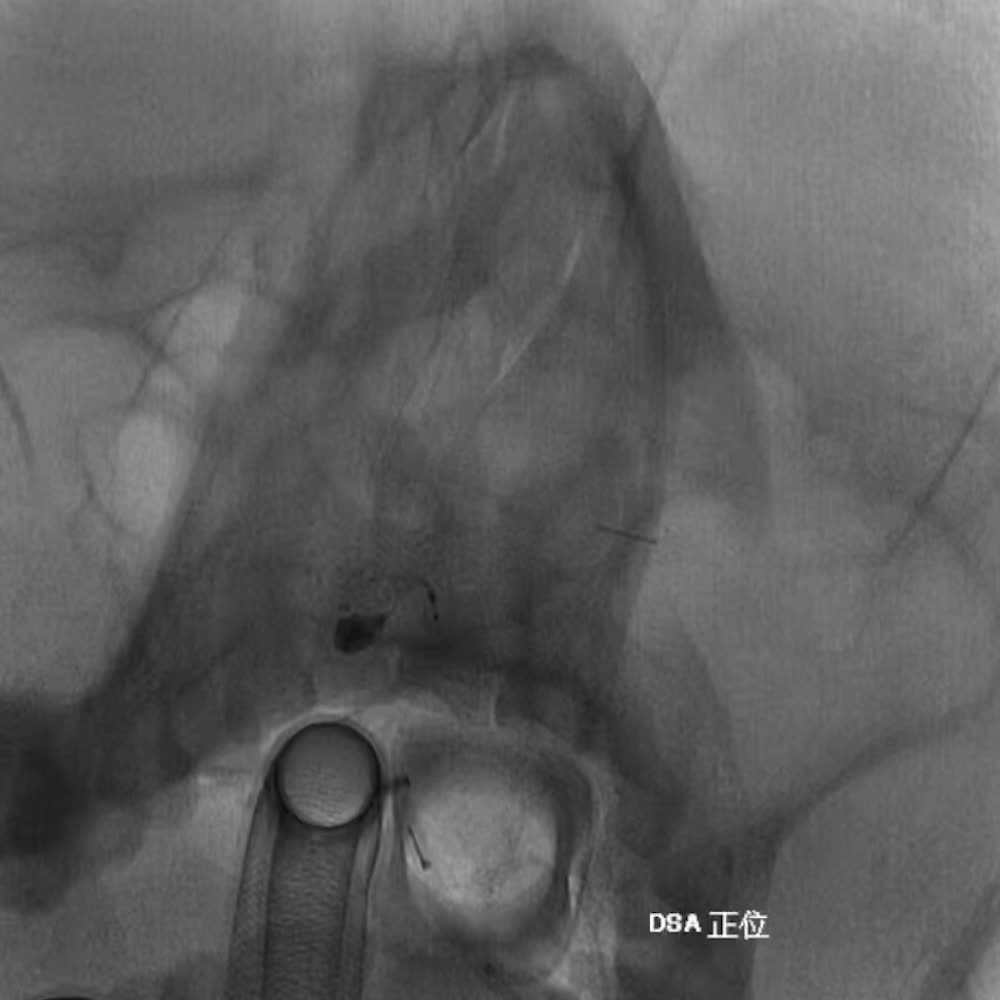 眼见为实｜LVIS™ EVO™支架全国首批植入：左侧颈内动脉交通段动脉瘤治疗一例 - 脑医汇