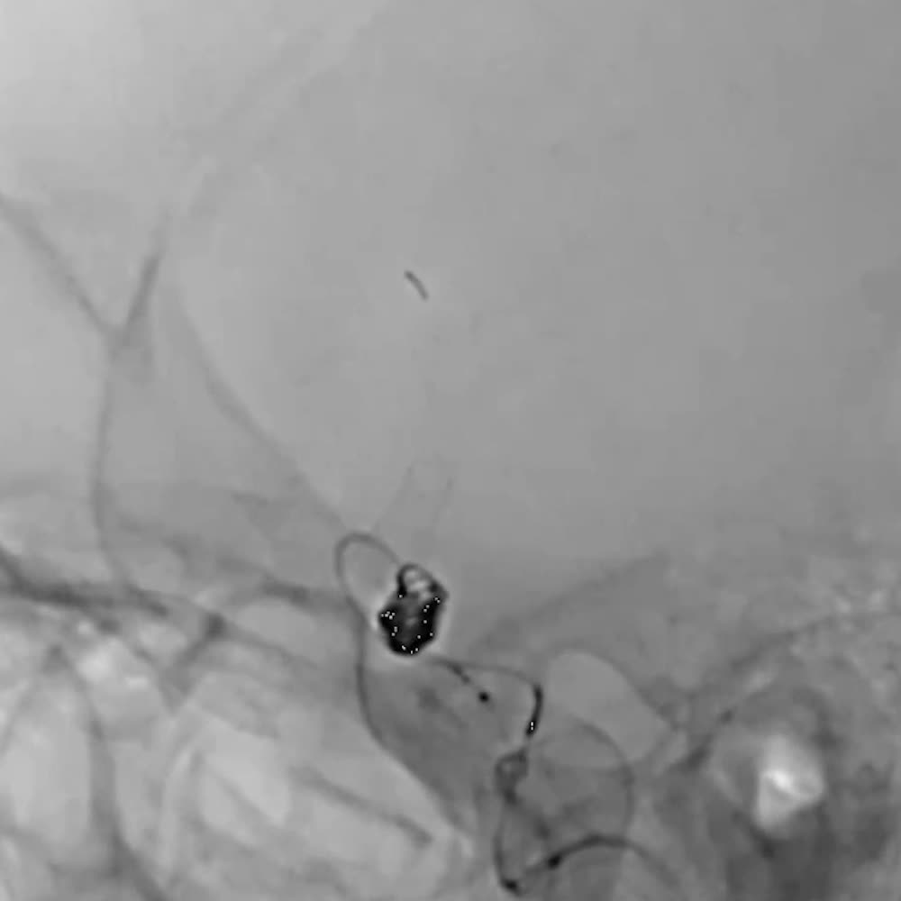 眼见为实｜LVIS™ EVO™支架全国首批植入：颅内动脉瘤治疗两例 - 脑医汇