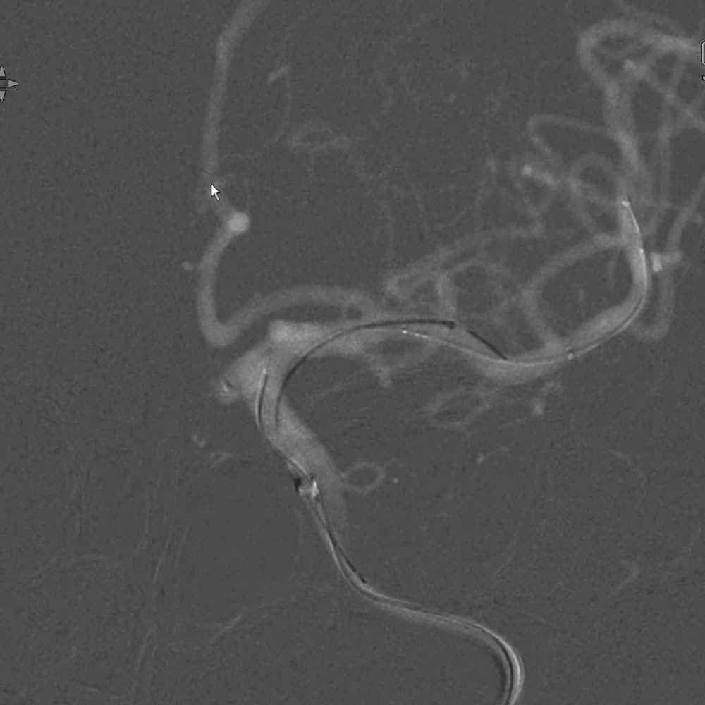 眼见为实｜LVIS™ EVO™支架全国首批植入：左侧颈内动脉C6段动脉瘤治疗一例 - 脑医汇