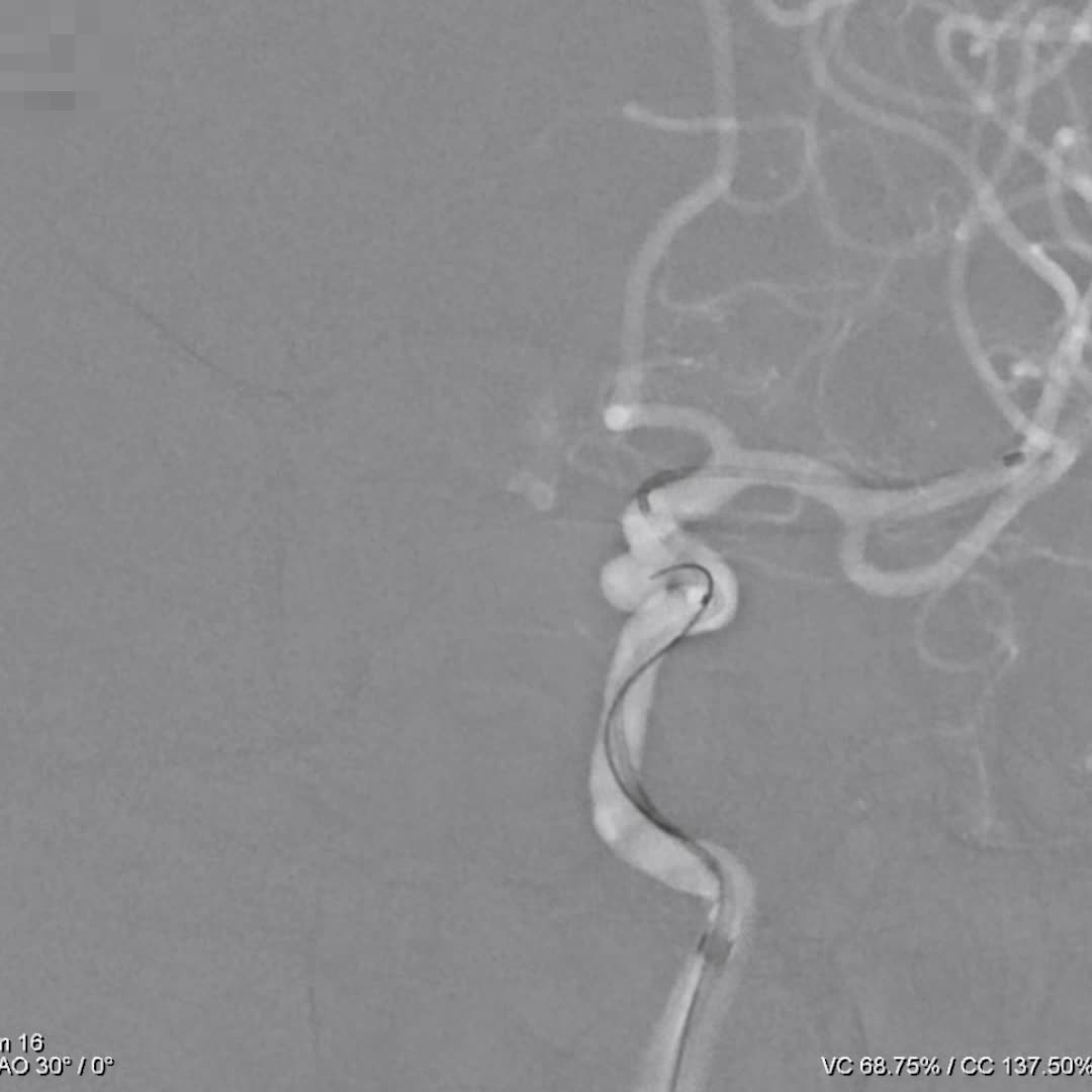 持久塑形 随心所控｜杨毅兵：Synchro Select导丝临床应用病例集锦 - 脑医汇