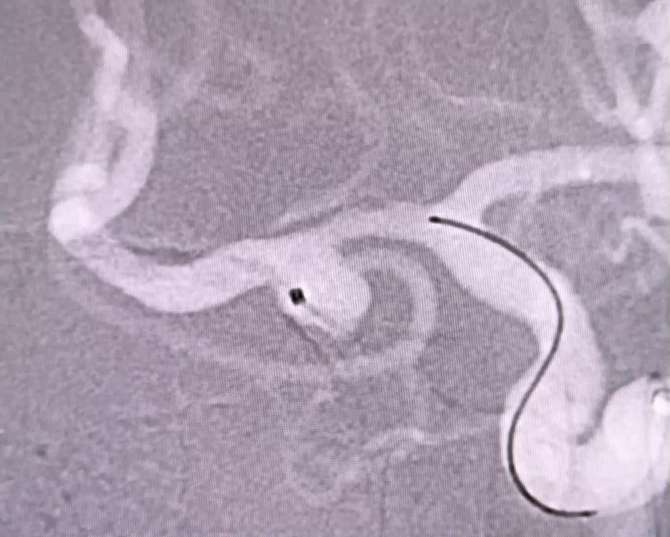 【病例夹】全国首批植入——何旭英教授：WEB™ 17瘤内扰流装置治疗动脉瘤 - 脑医汇
