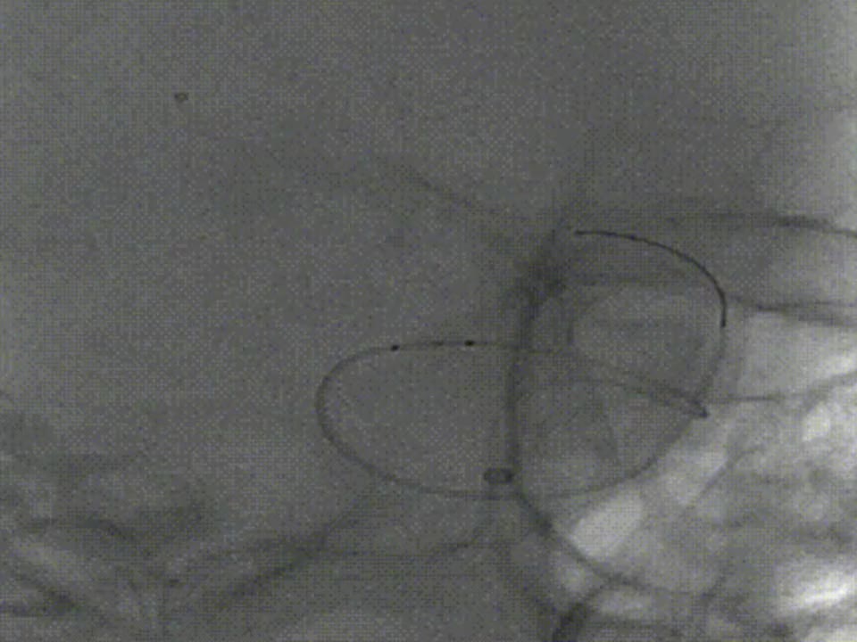 事成久稳丨浙江首例！Repath®血流导向密网支架治疗右侧海绵窦段巨大动脉瘤一例 - 脑医汇