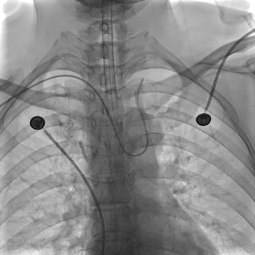 Rist 中国首秀集锦｜左侧ICA-C6段动脉瘤 经桡治疗实况 - 脑医汇