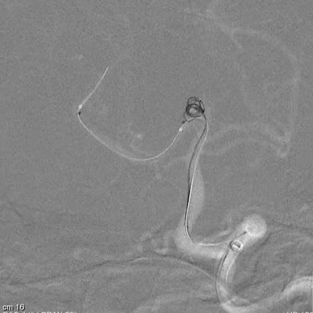 眼见为实｜LVIS™ EVO™支架全国首批植入：右侧大脑后动脉P1段动脉瘤治疗一例 - 脑医汇