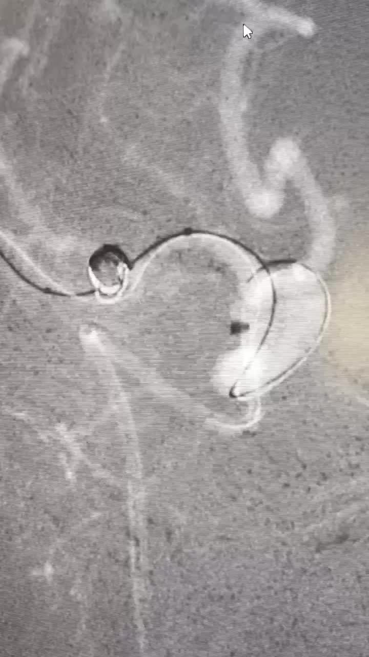 【有励可说】Juewa OTW球囊在大脑中动脉分叉部动脉瘤合并狭窄治疗中的应用 - 脑医汇