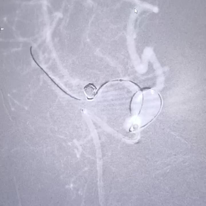 【有励可说】Juewa OTW球囊在大脑中动脉分叉部动脉瘤合并狭窄治疗中的应用 - 脑医汇