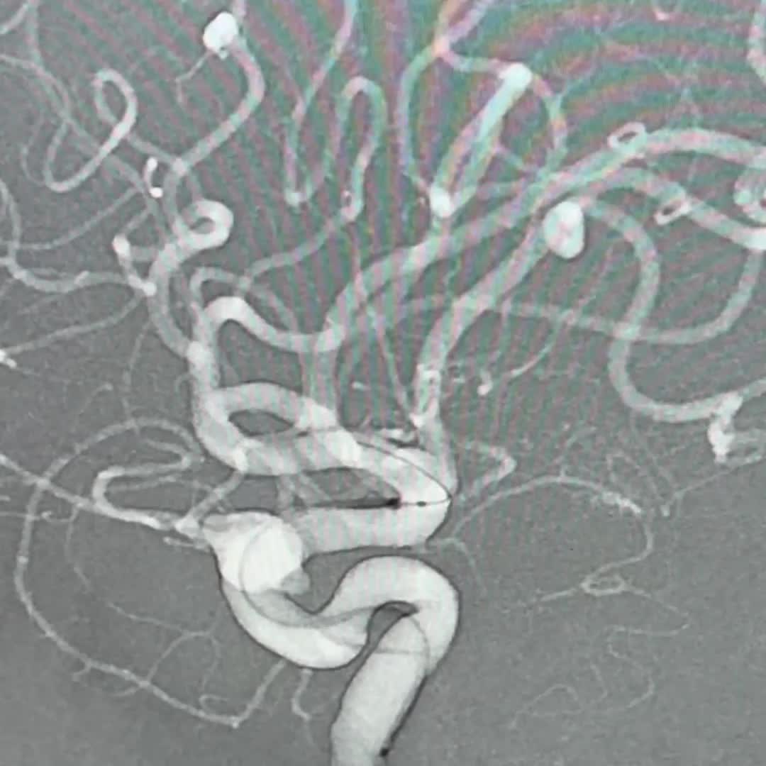 Time to Evolve 超越之旅｜Surpass Evolve支架治疗动脉瘤一例 - 脑医汇