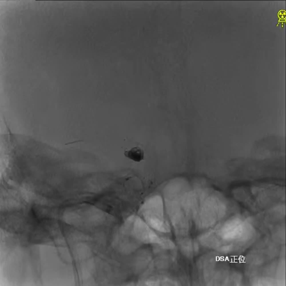 眼见为实｜LVIS™ EVO™支架全国首批植入：颅内动脉瘤治疗两例 - 脑医汇