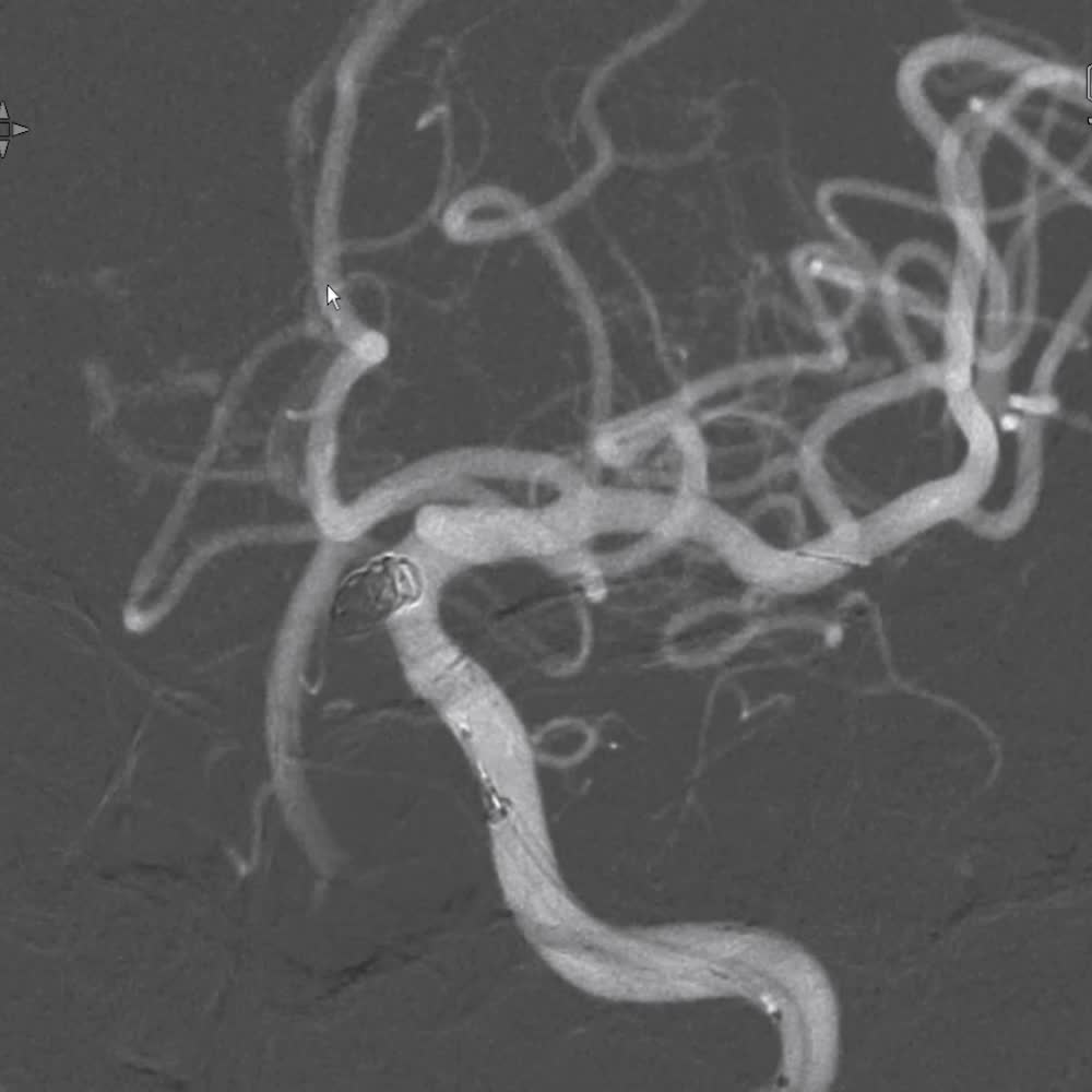 眼见为实｜LVIS™ EVO™支架全国首批植入：左侧颈内动脉C6段动脉瘤治疗一例 - 脑医汇