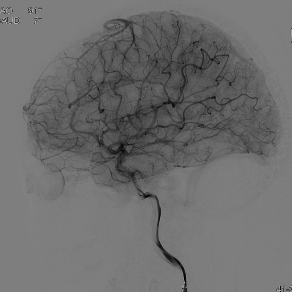 眼见为实｜LVIS™ EVO™支架全国首批植入：左侧颈内动脉C6段动脉瘤治疗一例 - 脑医汇