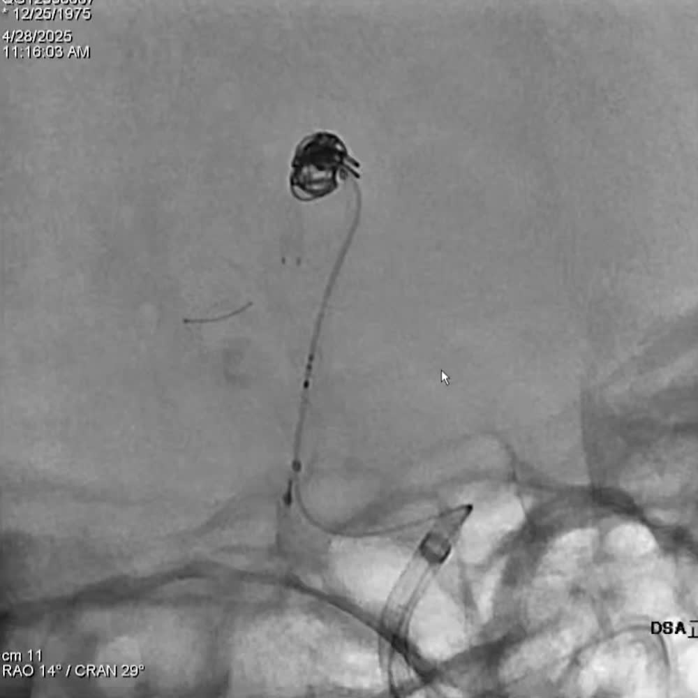 眼见为实｜LVIS™ EVO™支架全国首批植入：右侧大脑后动脉P1段动脉瘤治疗一例 - 脑医汇