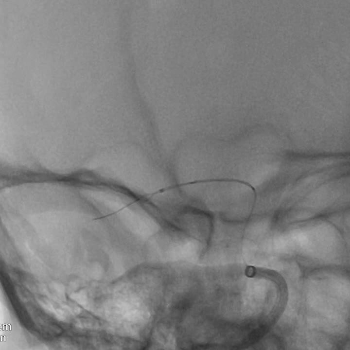 强易达Choydar血流导向装置治疗动脉瘤两例—华东首秀 - 脑医汇 - 神外资讯 - 神介资讯
