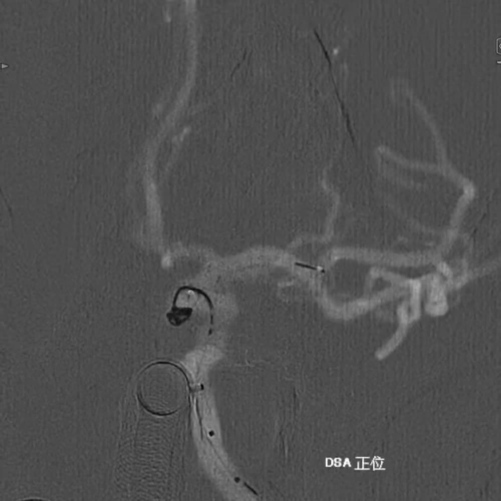 眼见为实｜LVIS™ EVO™支架全国首批植入：左侧颈内动脉交通段动脉瘤治疗一例 - 脑医汇