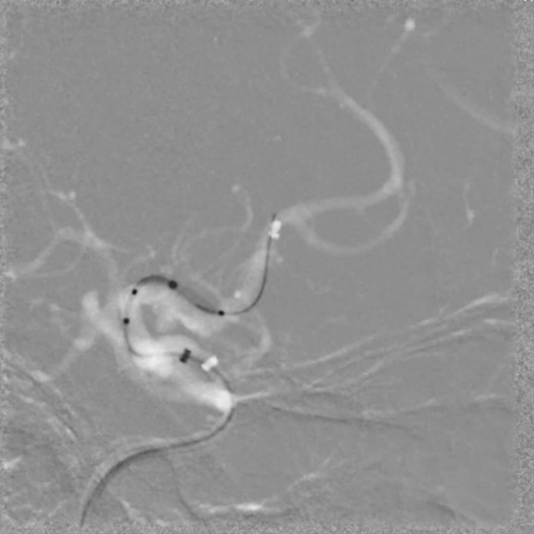 Time to Evolve 超越之旅 | Surpass Evolve支架治疗大脑前动脉A1段动脉瘤 - 脑医汇